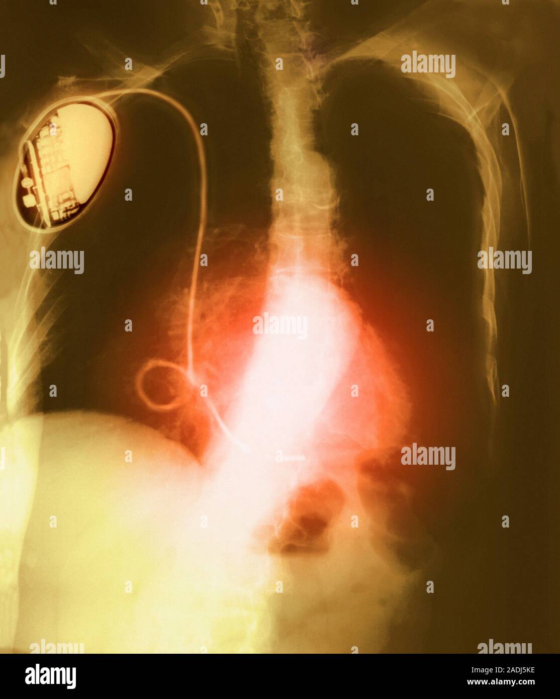 Heart pacemaker. Coloured chest X-ray showing a surgically-implanted ...