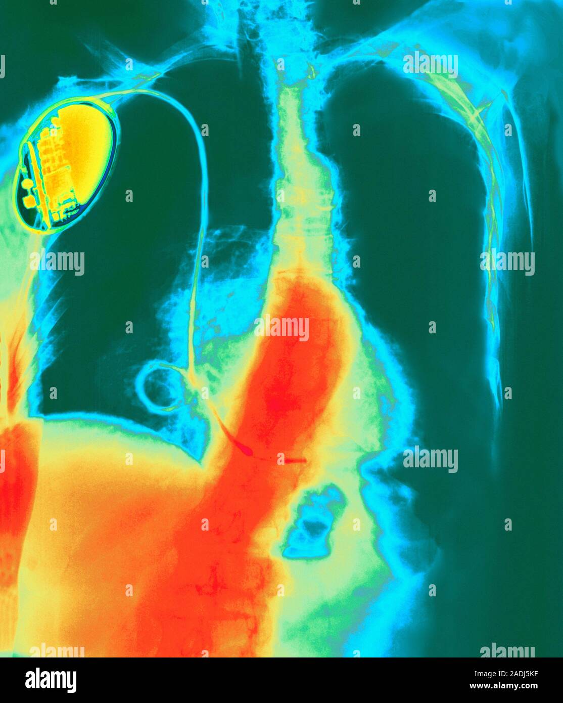 Heart pacemaker. Coloured chest X-ray showing a surgically-implanted ...