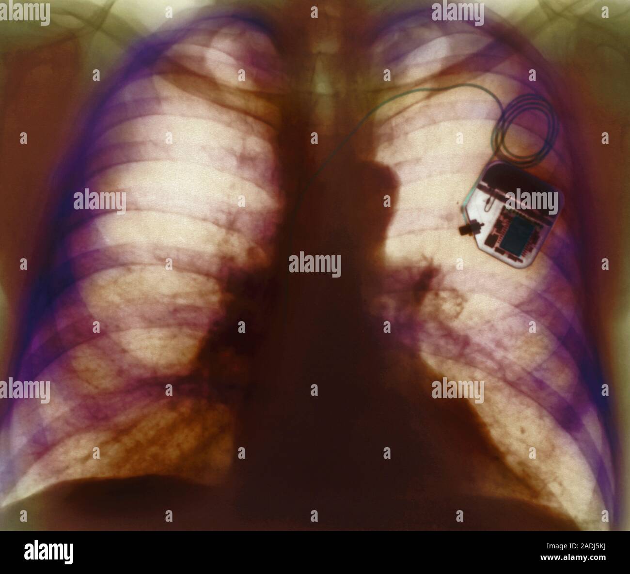 Heart Pacemaker Coloured Chest X Ray Showing A Surgically Implanted Heart Pacemaker At Upper