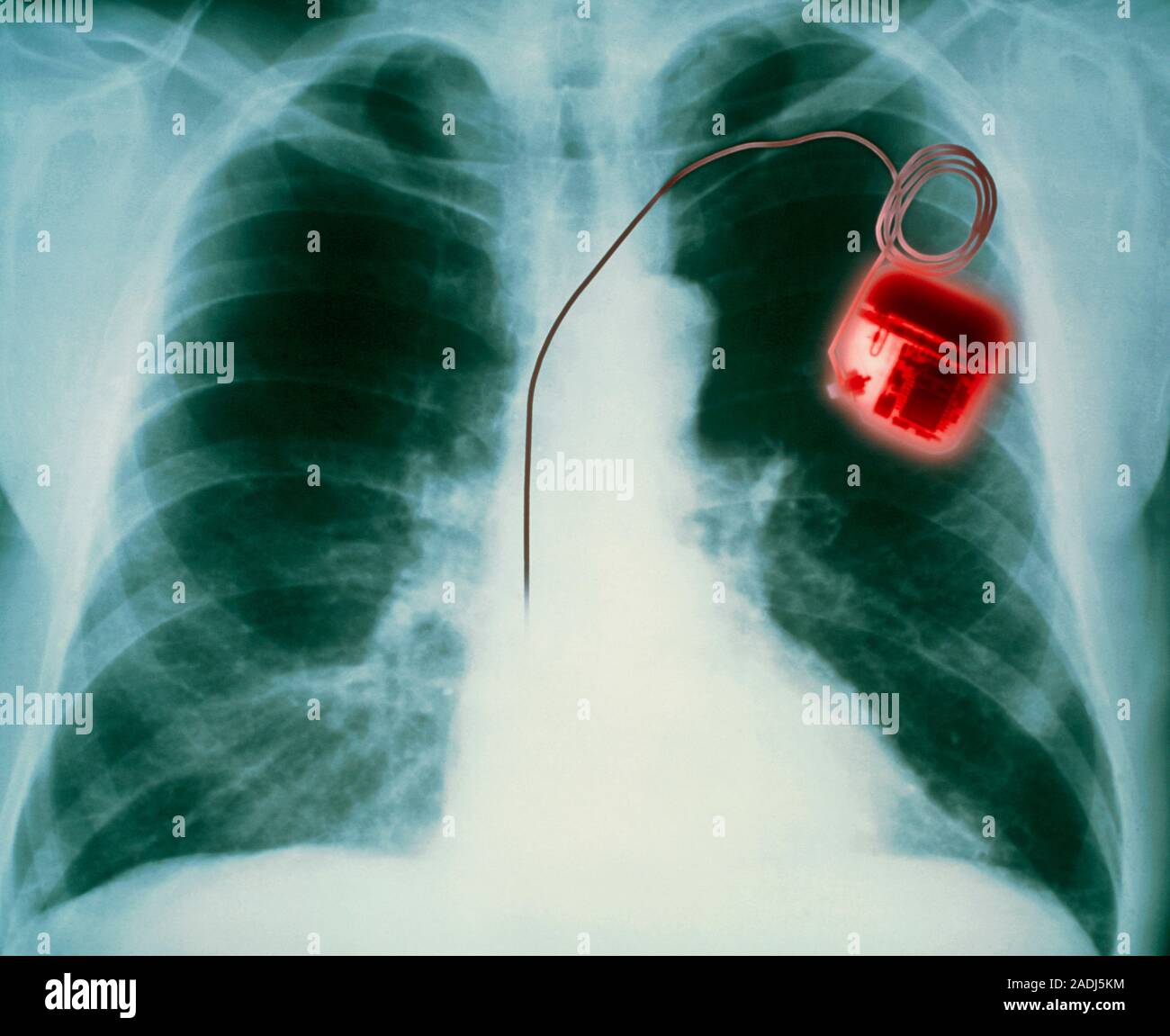 Heart Pacemaker Coloured Chest X Ray Showing A Surgically Implanted Heart Pacemaker Red Upper