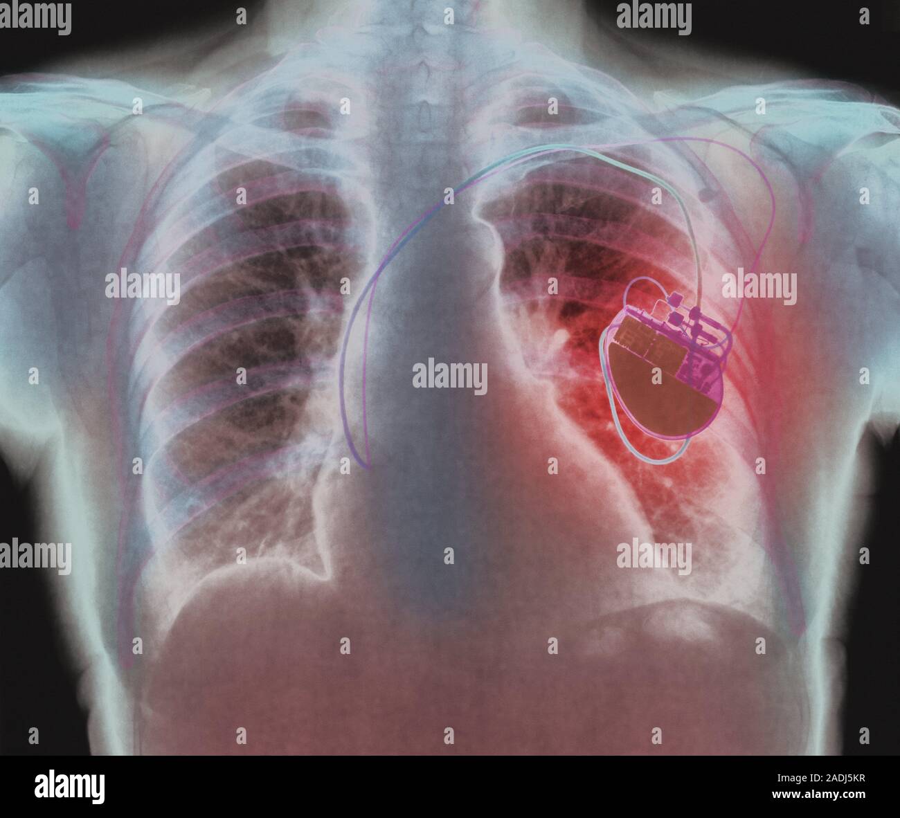 Heart pacemaker. Coloured chest X-ray showing a surgically-implanted ...