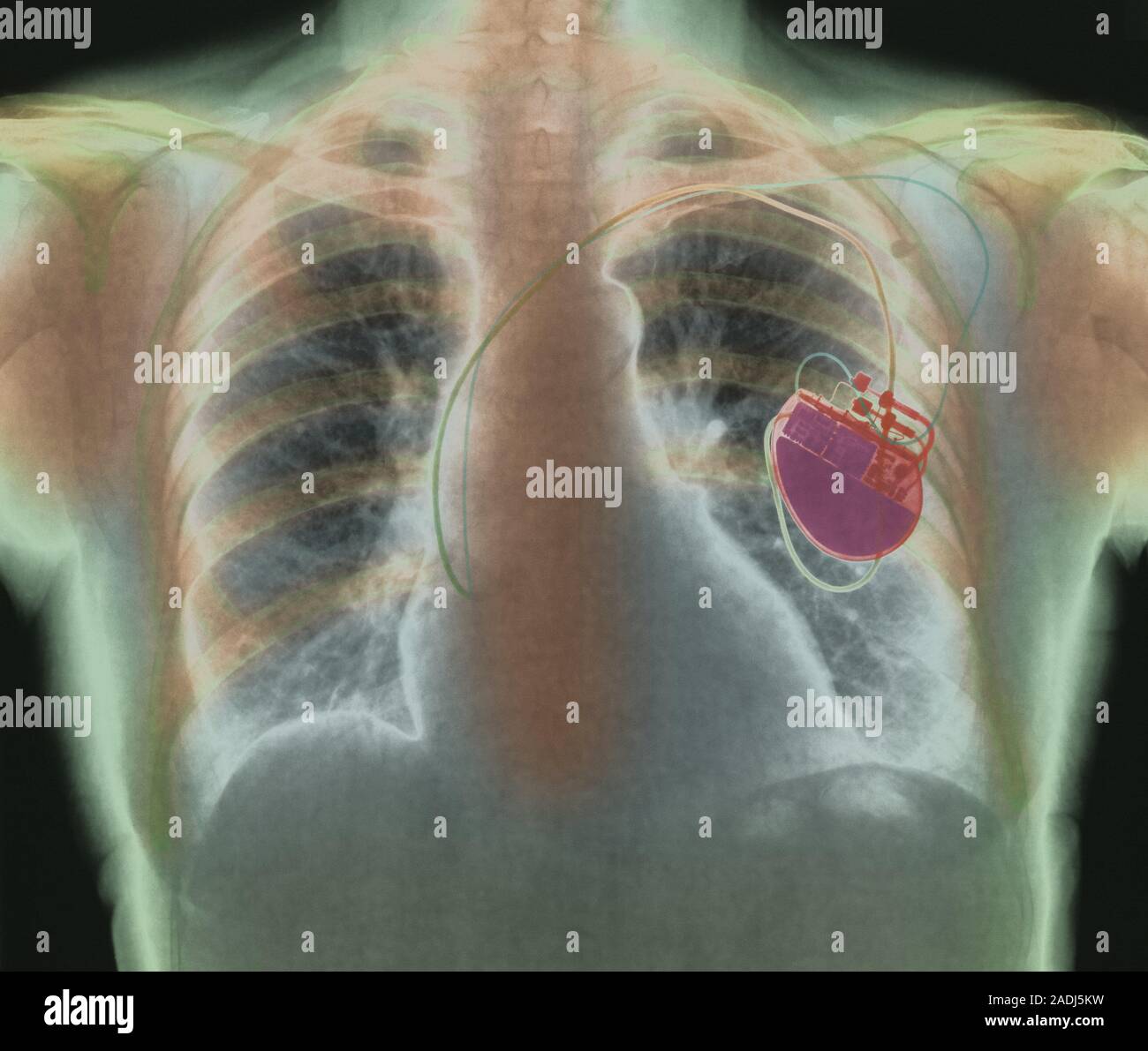 Heart pacemaker. Coloured chest X-ray showing a surgically-implanted ...
