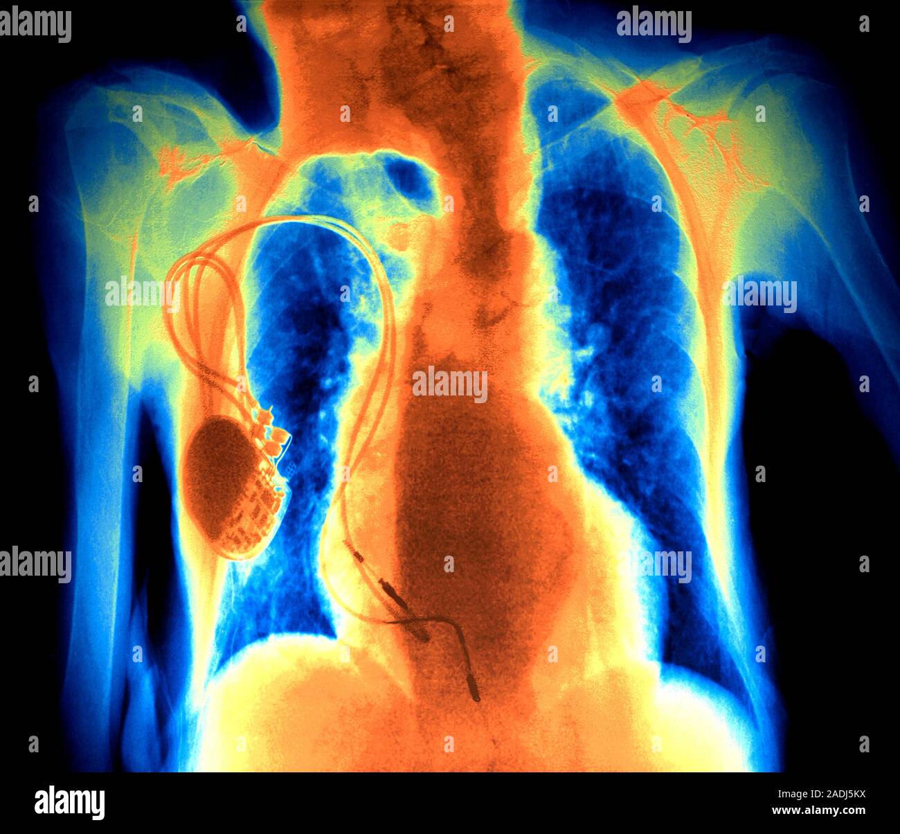 Heart Pacemaker Coloured Chest X Ray Showing A Surgically Implanted Heart Pacemaker Round