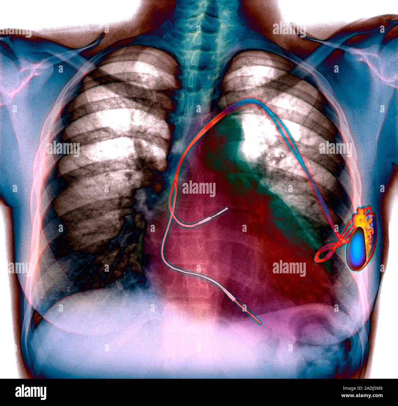 Heart pacemaker. Coloured chest X-ray showing a surgically-implanted ...