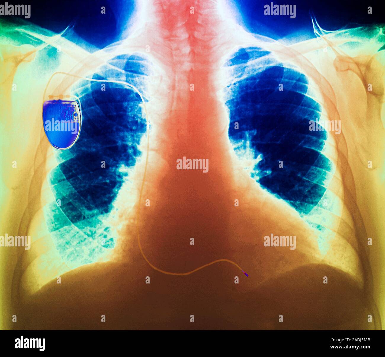 Heart pacemaker. Coloured chest X-ray showing a surgically-implanted ...