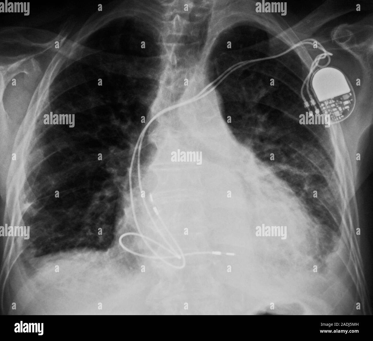 Heart pacemaker. Frontal X-ray of the chest of a patient with a heart ...