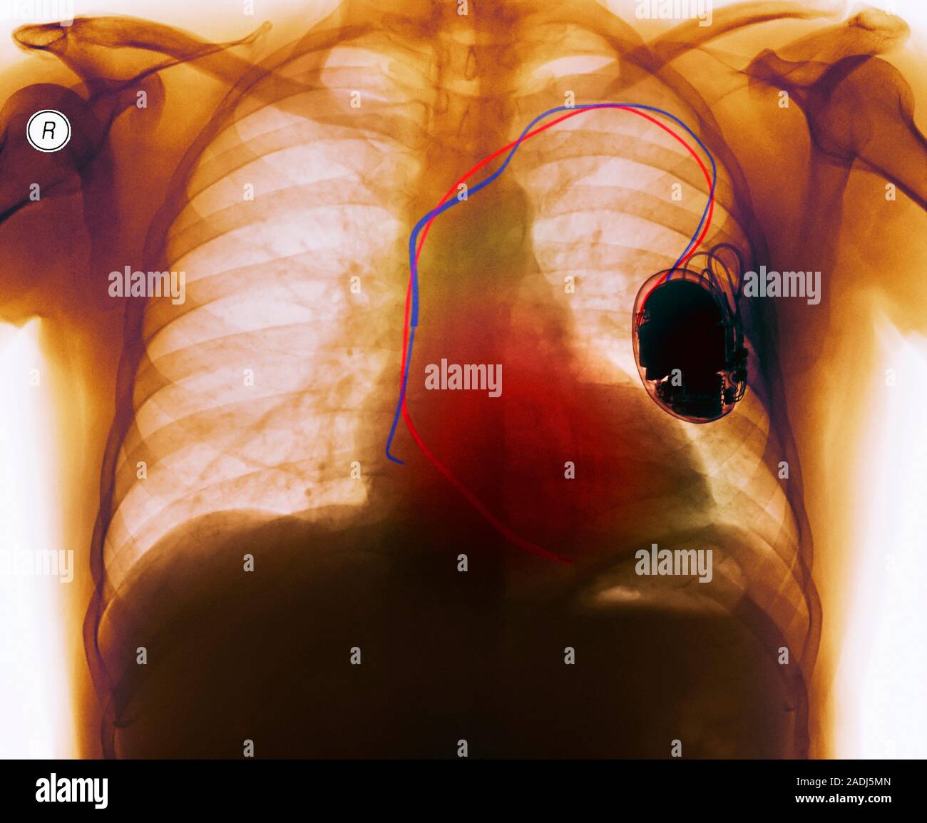 Heart pacemaker. Coloured frontal X-ray of the chest of a male patient ...