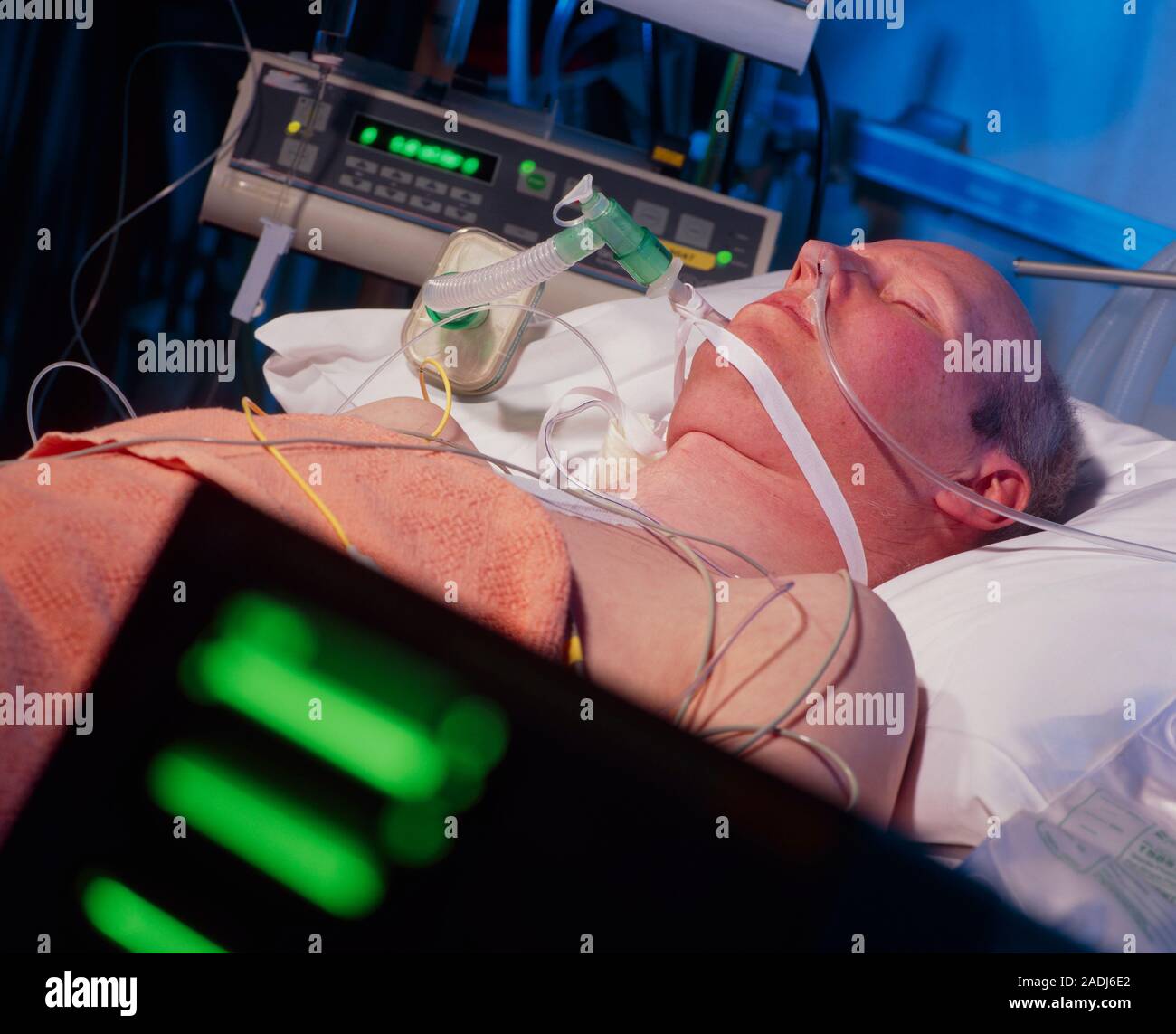 Cardiac intensive care. Male patient having undergone heart surgery ...