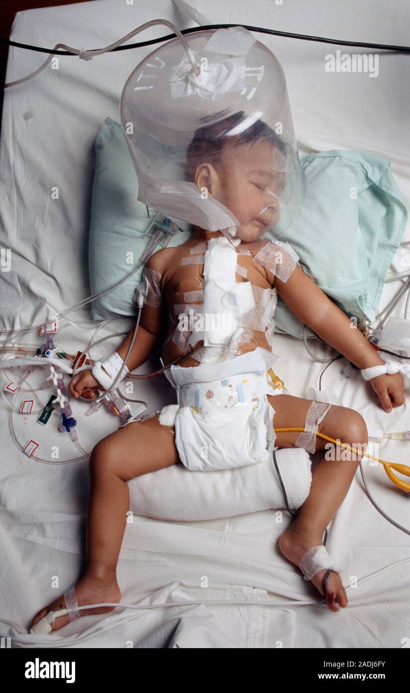 Heart surgery patient. Baby in intensive care after open heart surgery ...