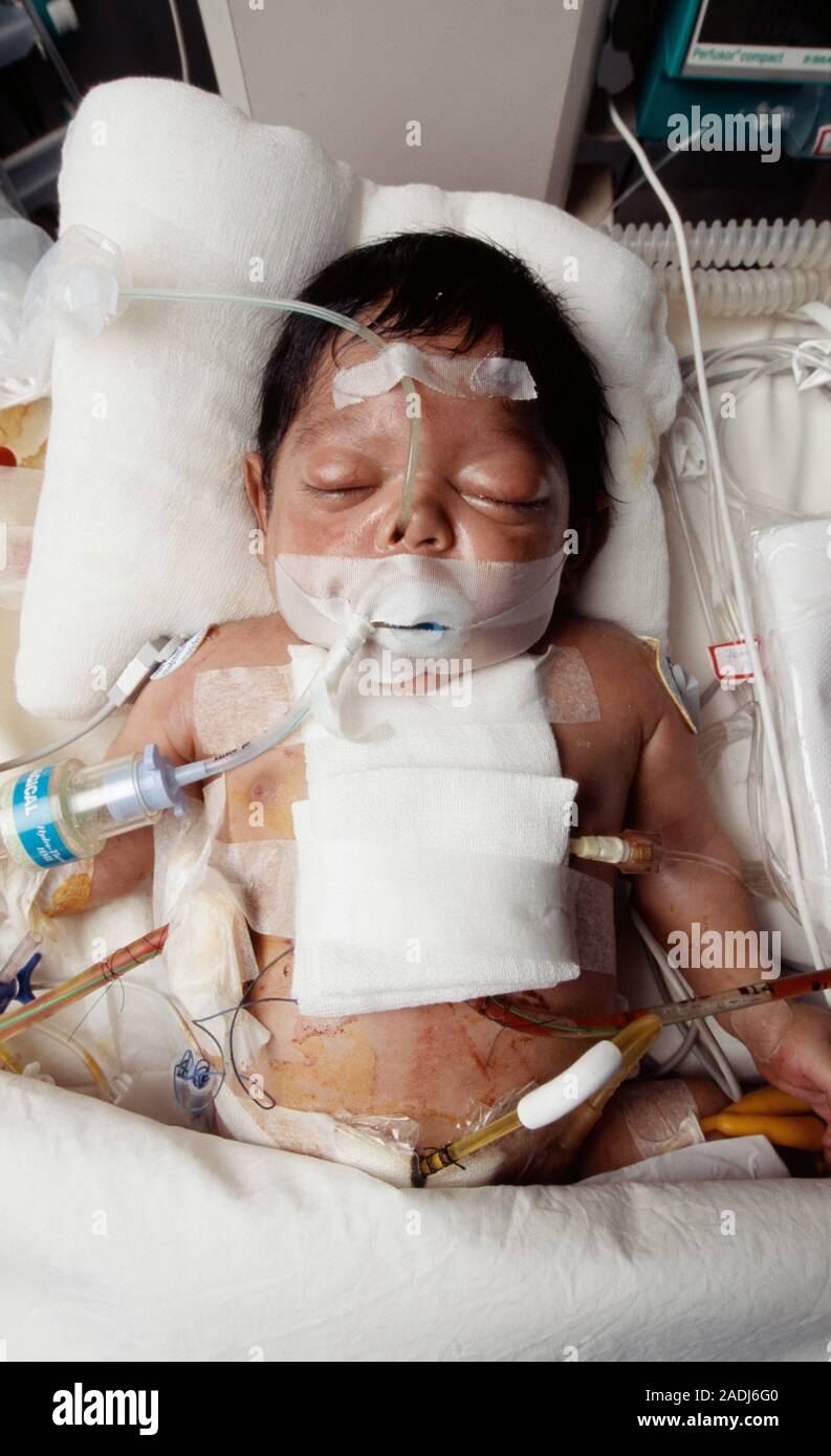 Heart surgery patient. Baby in intensive care after open heart surgery ...