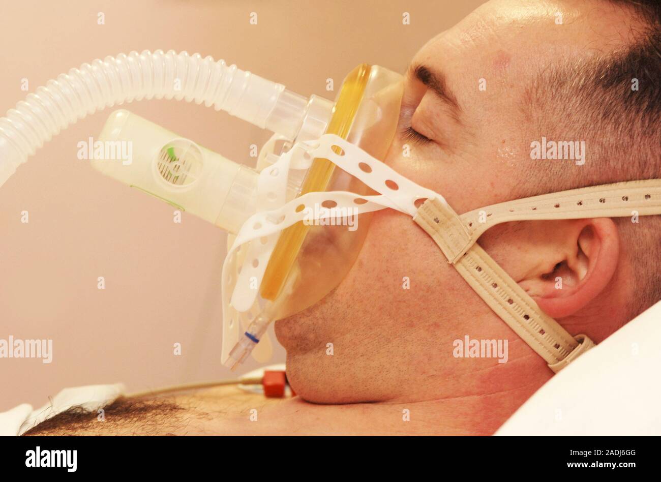 MODEL RELEASED. Intensive care patient. Side-view of the face of a male ...