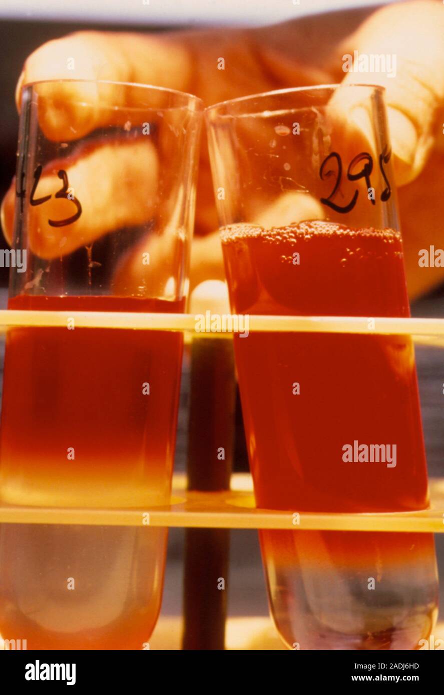 Tubes of blood prepared for HL-A tissue typing. The histocompatibility ...