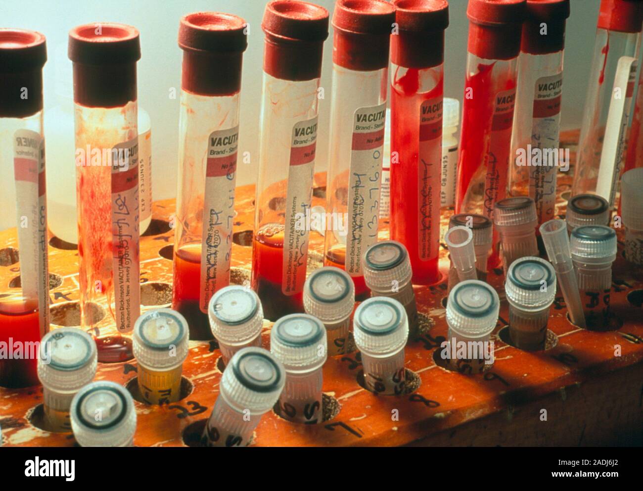 Blood and serum samples. Rack of blood specimen tubes in a haematology ...