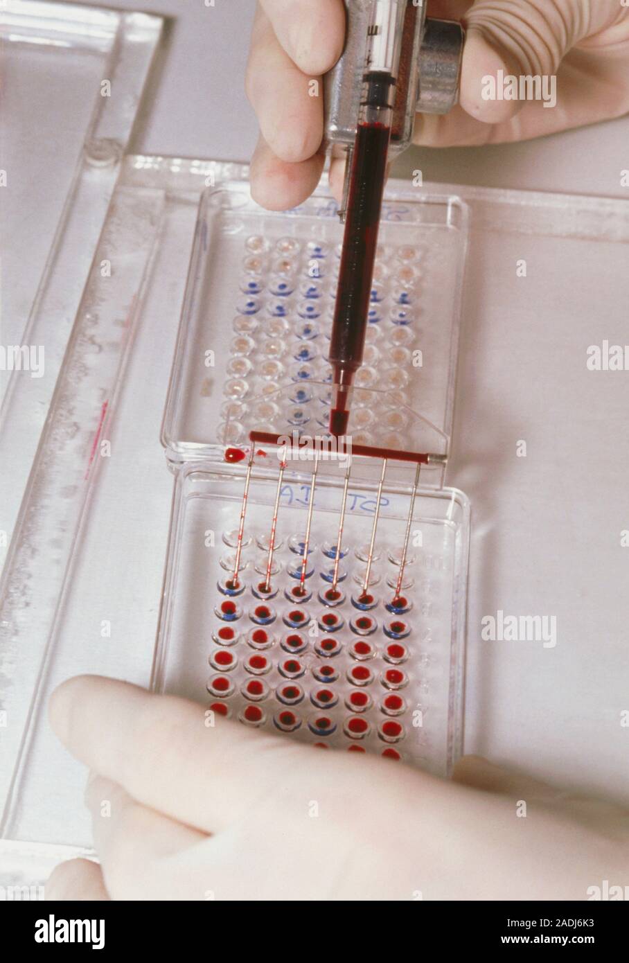 Blood test. Multi-pipette puts blood samples into a multi-well sample ...