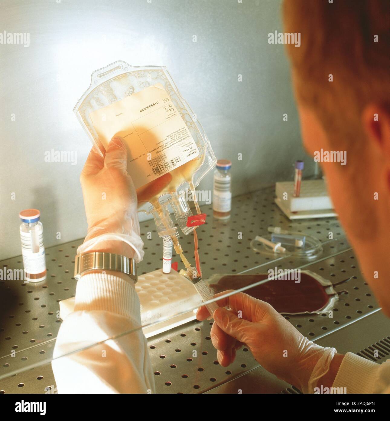 Umbilical cord blood testing. Technician sampling a bag of umbilical ...