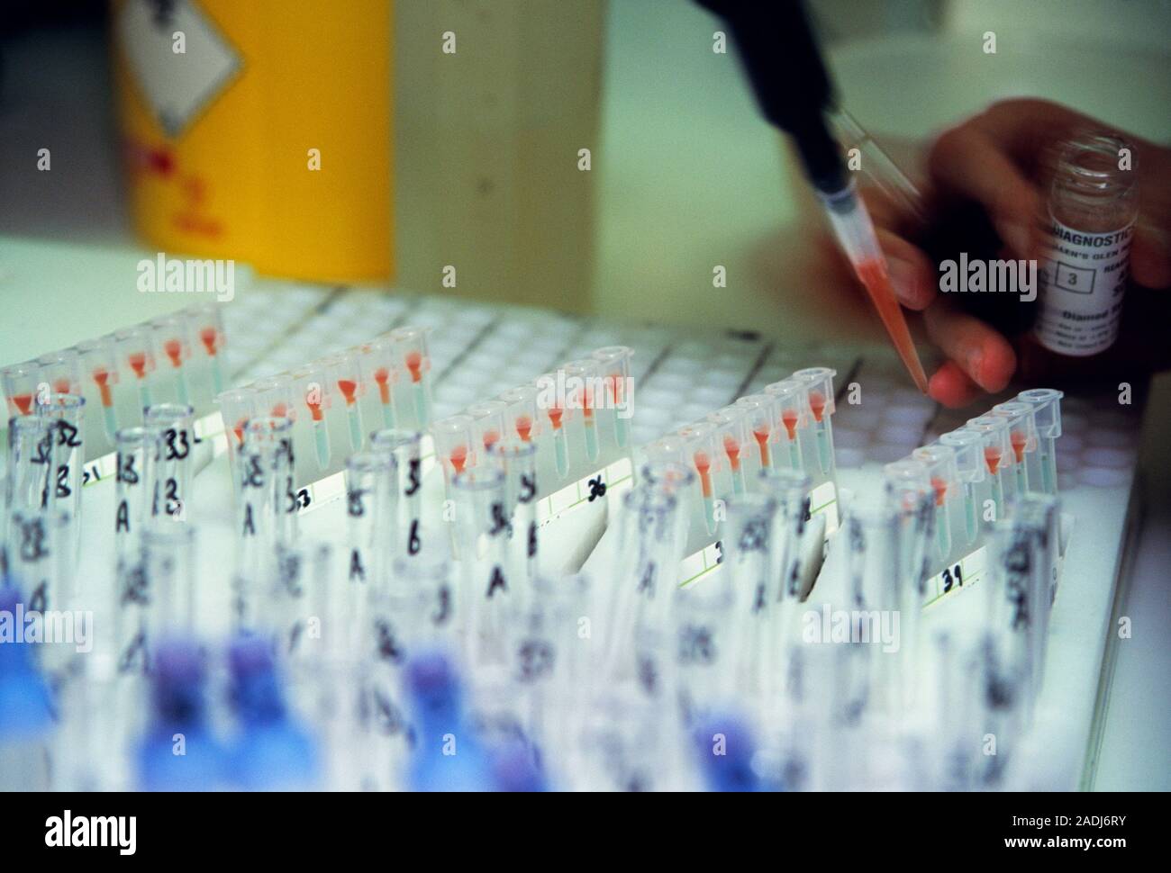 Blood group test. Technician using a pipette to transfer a quantity of ...