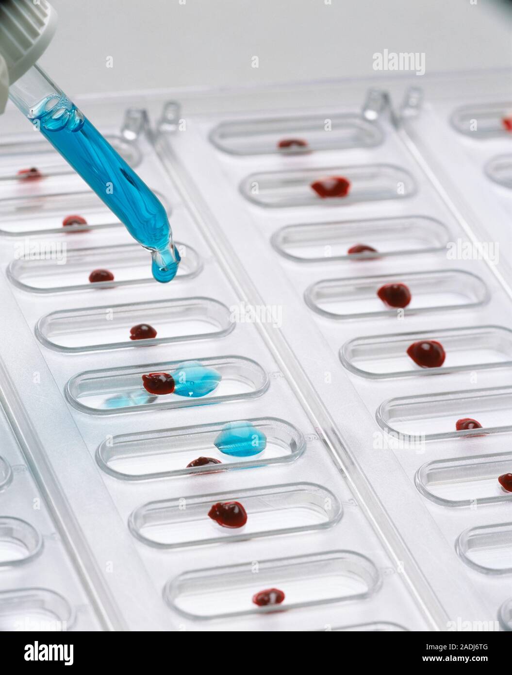 Blood group test. Pipette being used to add serum containing blood ...