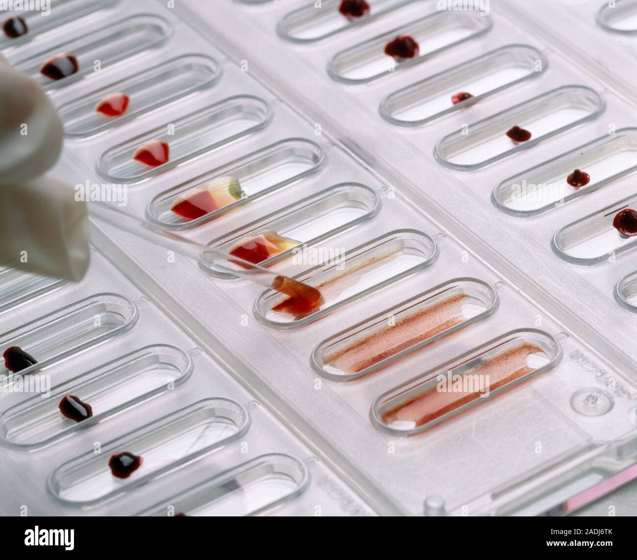 Blood group test. Image 3 of 4. Pipette being used to mix blood group B ...