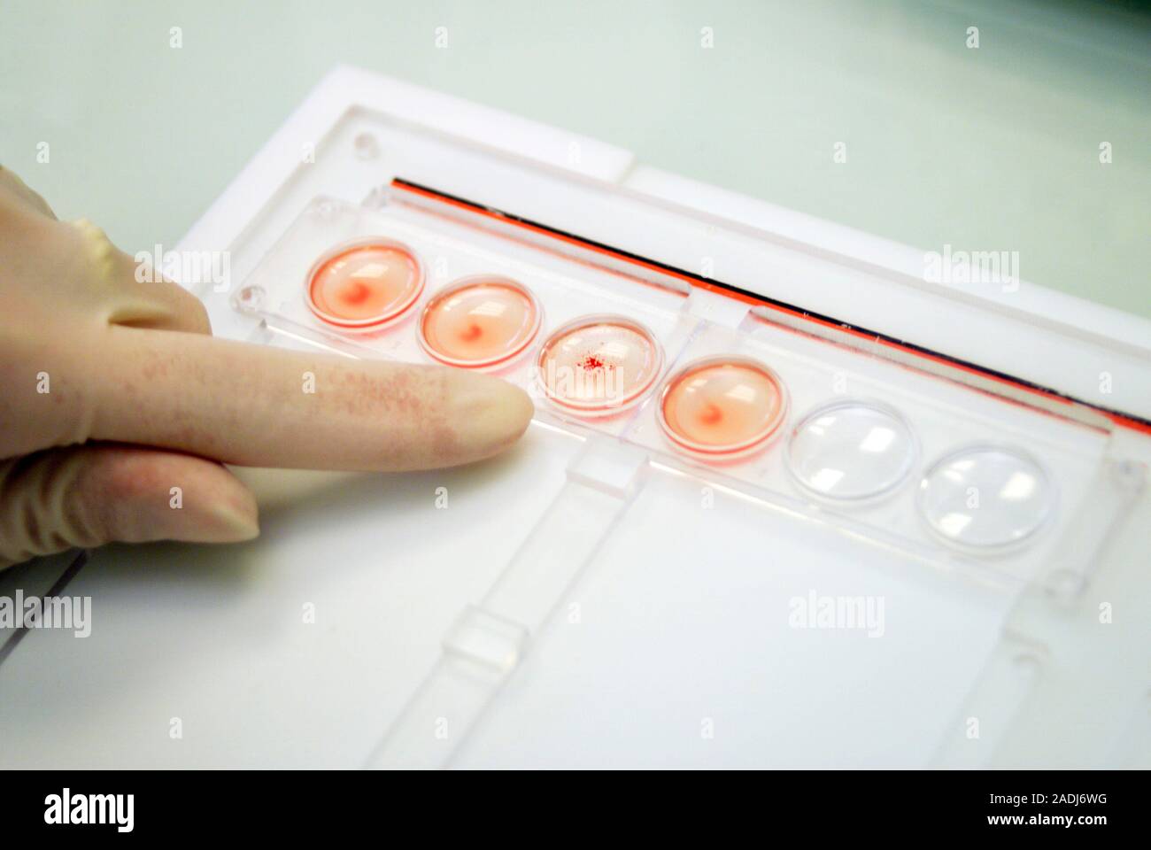Blood grouping. Laboratory technician pointing to a sample of blood ...