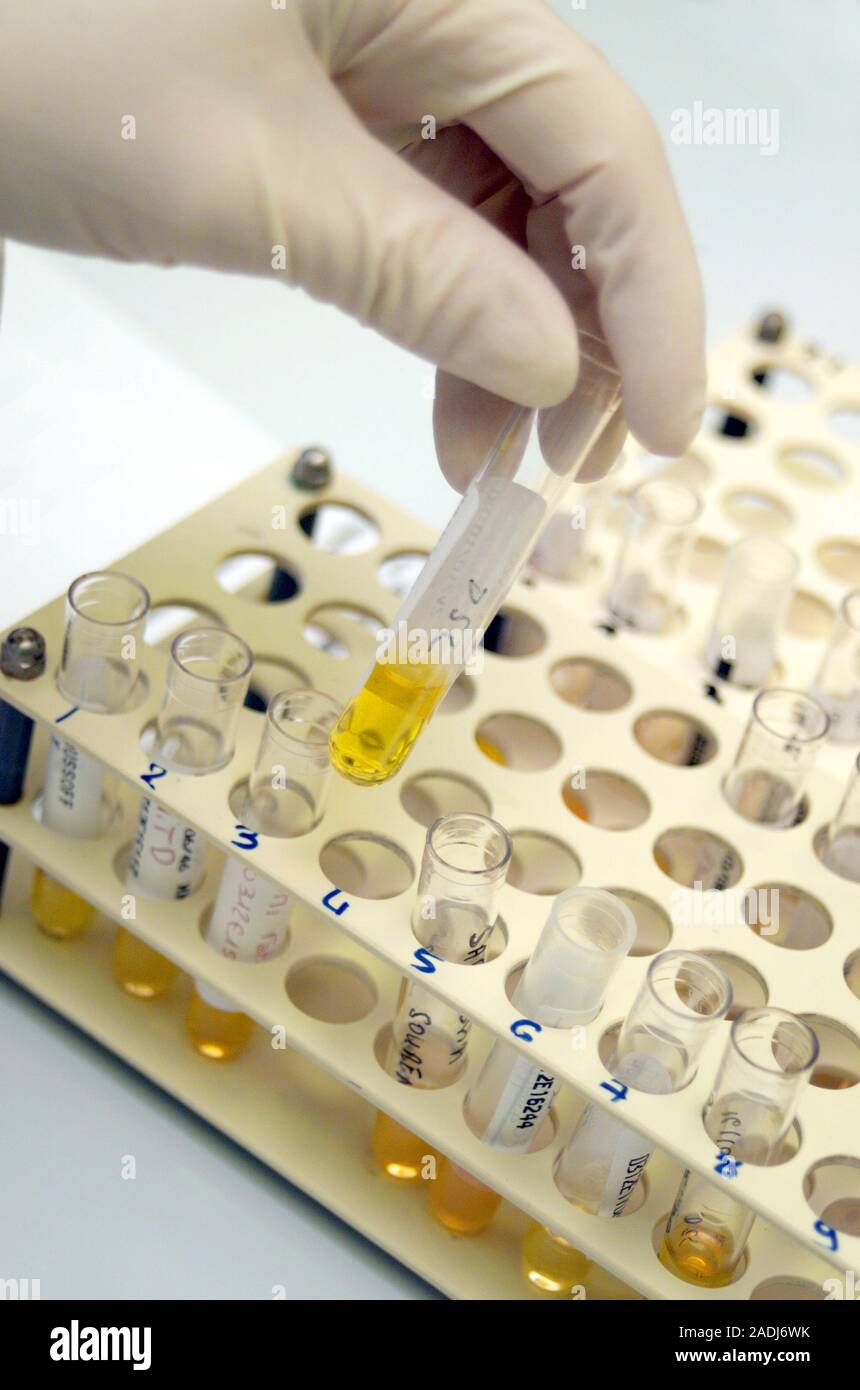 Blood serum. Laboratory technician holding a sample tube containing ...