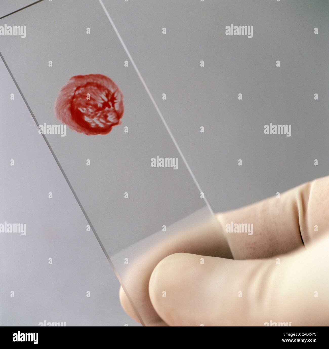 Blood sample on a microscope slide. Gloved hand holding a microscope ...