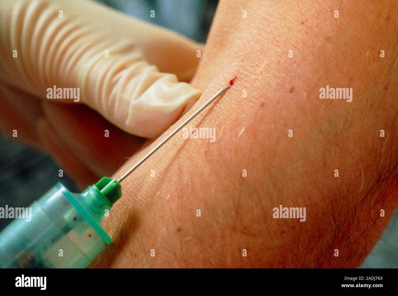 Blood sampling. Close-up view of the drawing of a blood sample from a ...