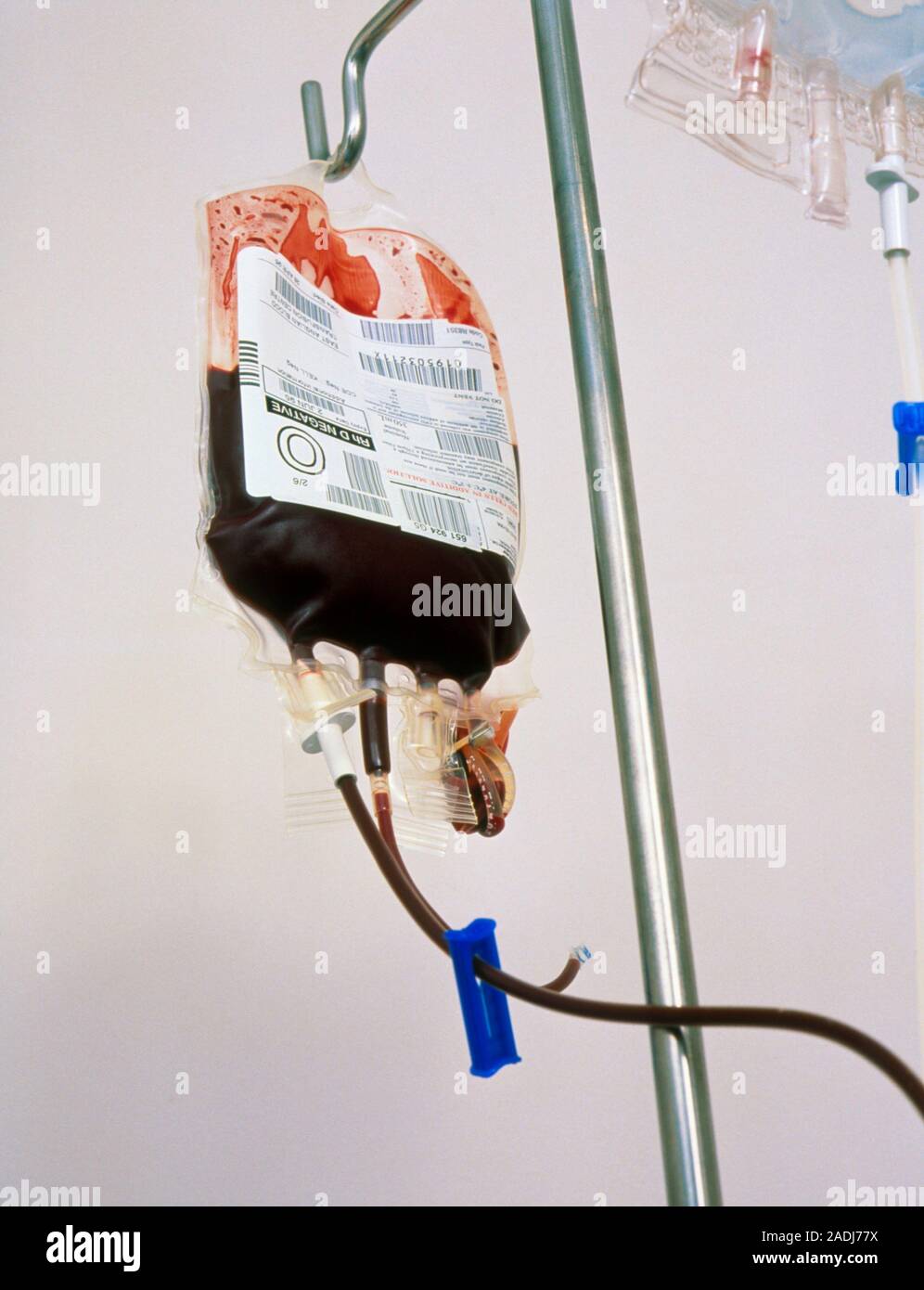 Bag of blood. This blood bag hanging from a stand is used for blood ...