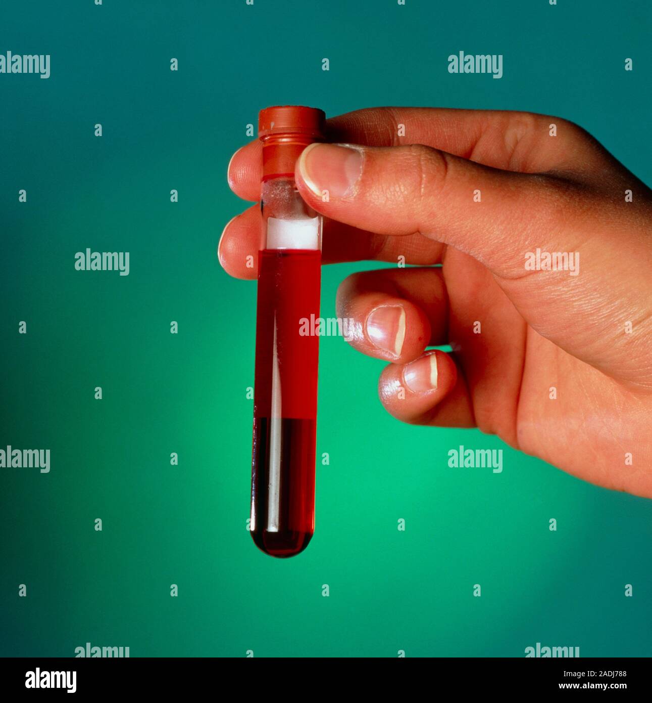 Blood sample. Hand holds a sterile test tube containing a blood sample ...