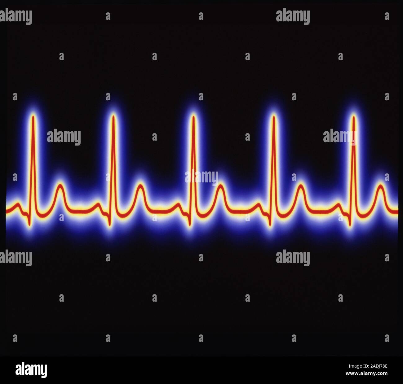 Heart trace. Computer illustration of the trace of a normal human pulse ...
