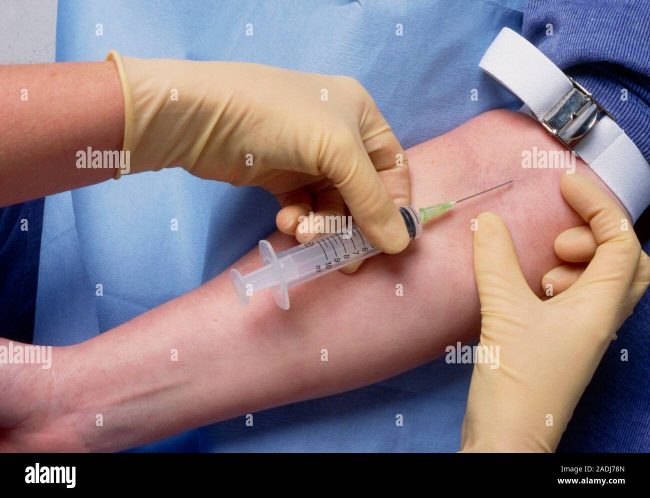 Blood sampling. Gloved hands placing a syringe in a vein in the arm in ...