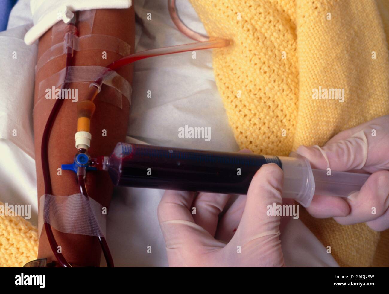 Sickle cell blood transfusion. Pregnant female patient with sickle cell ...