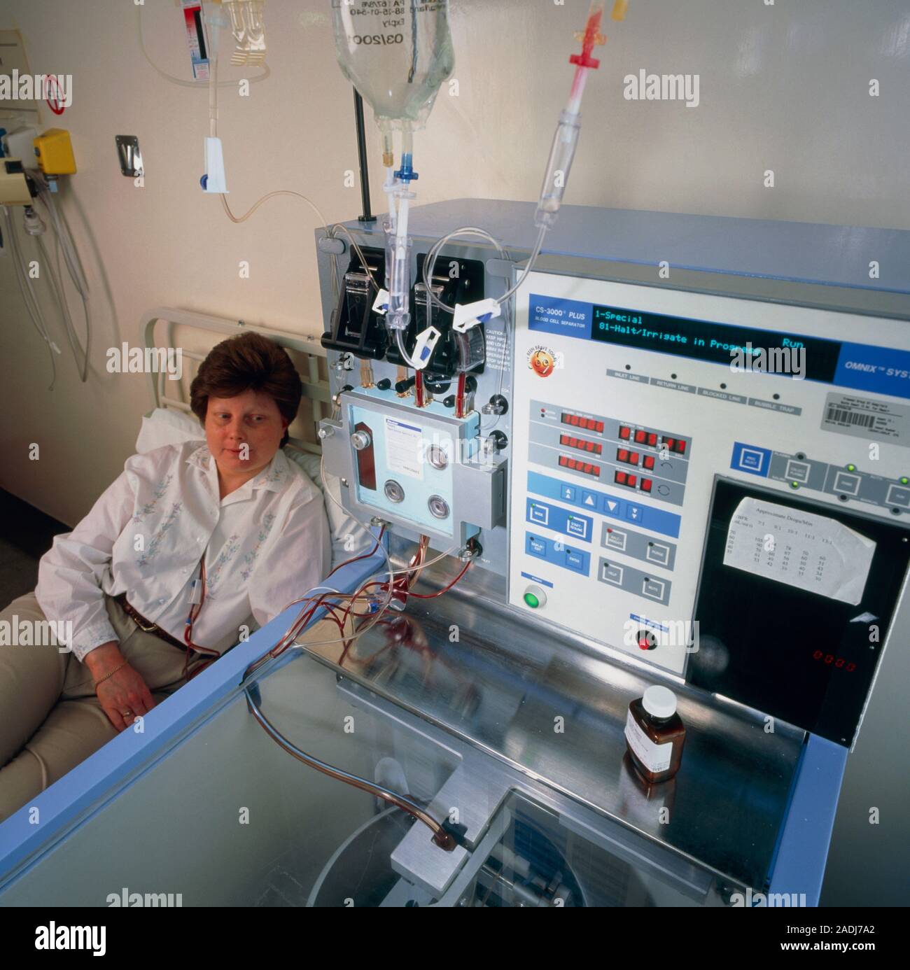 Blood stem cell harvesting. Woman attached to a blood cell separating ...