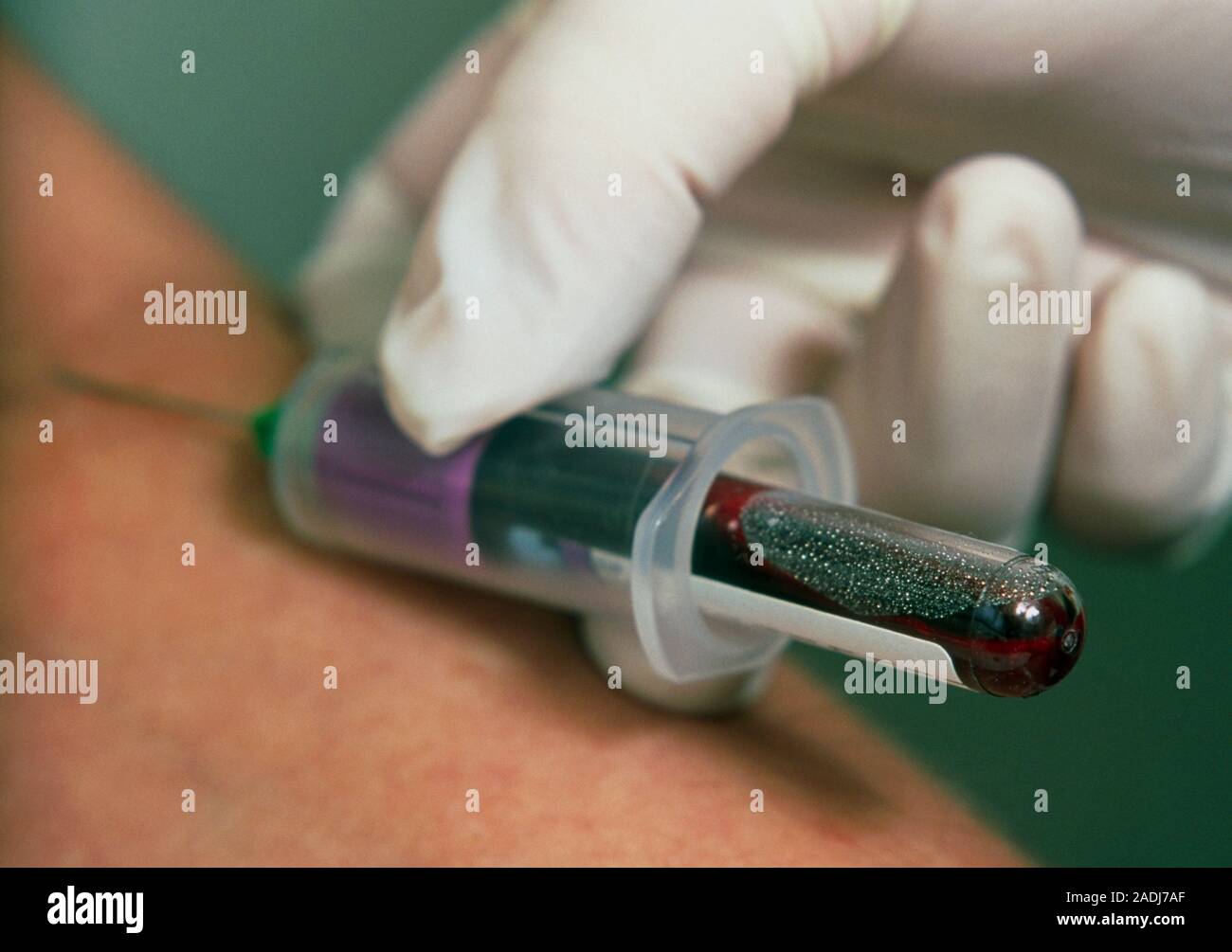 Blood sampling. Gloved hand using a vacutainer to obtain a blood sample ...