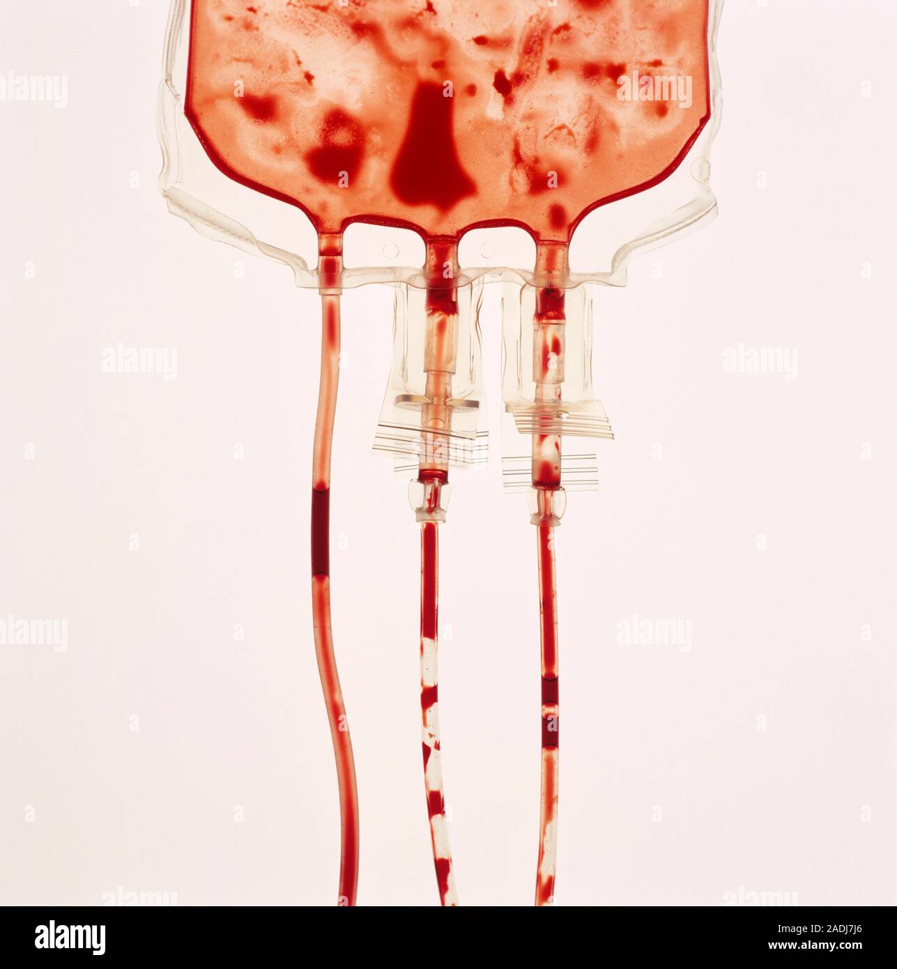 Empty blood bag. Bag of blood emptied after a transfusion. The bag was ...