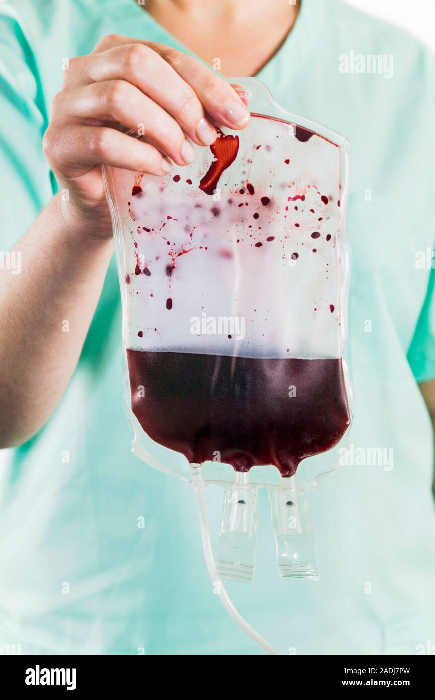 Blood transfusion. Nurse holding a blood bag during a blood transfusion ...