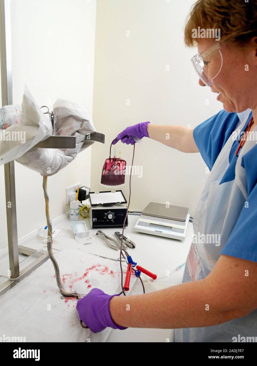 Harvesting umbilical cord stem cells. Nurse collecting blood from a ...