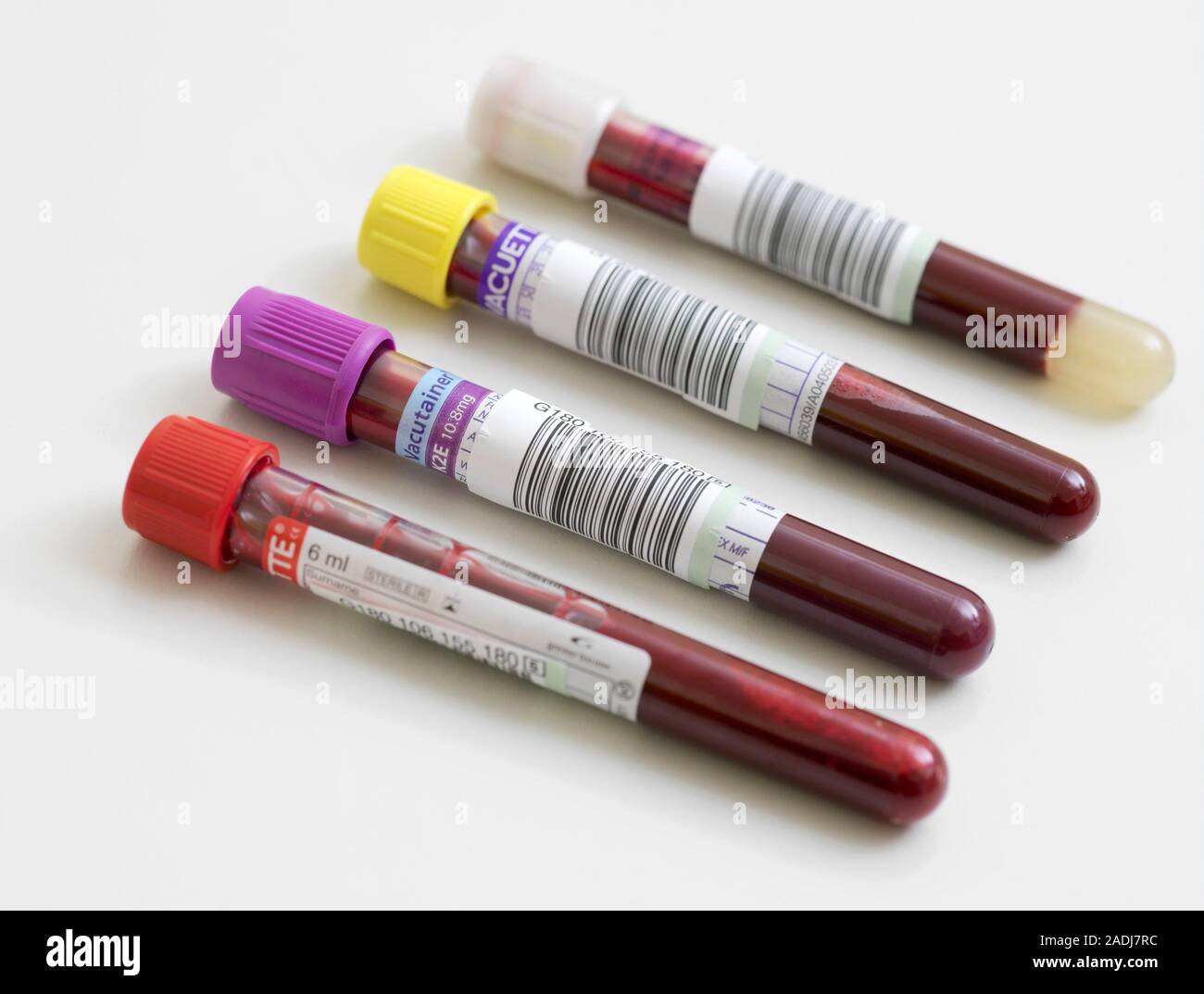 Umbilical cord blood for stem cell harvesting. Four sample tubes ...