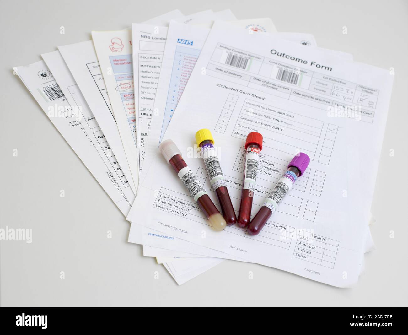 Umbilical cord blood for stem cell harvesting. Four sample tubes ...