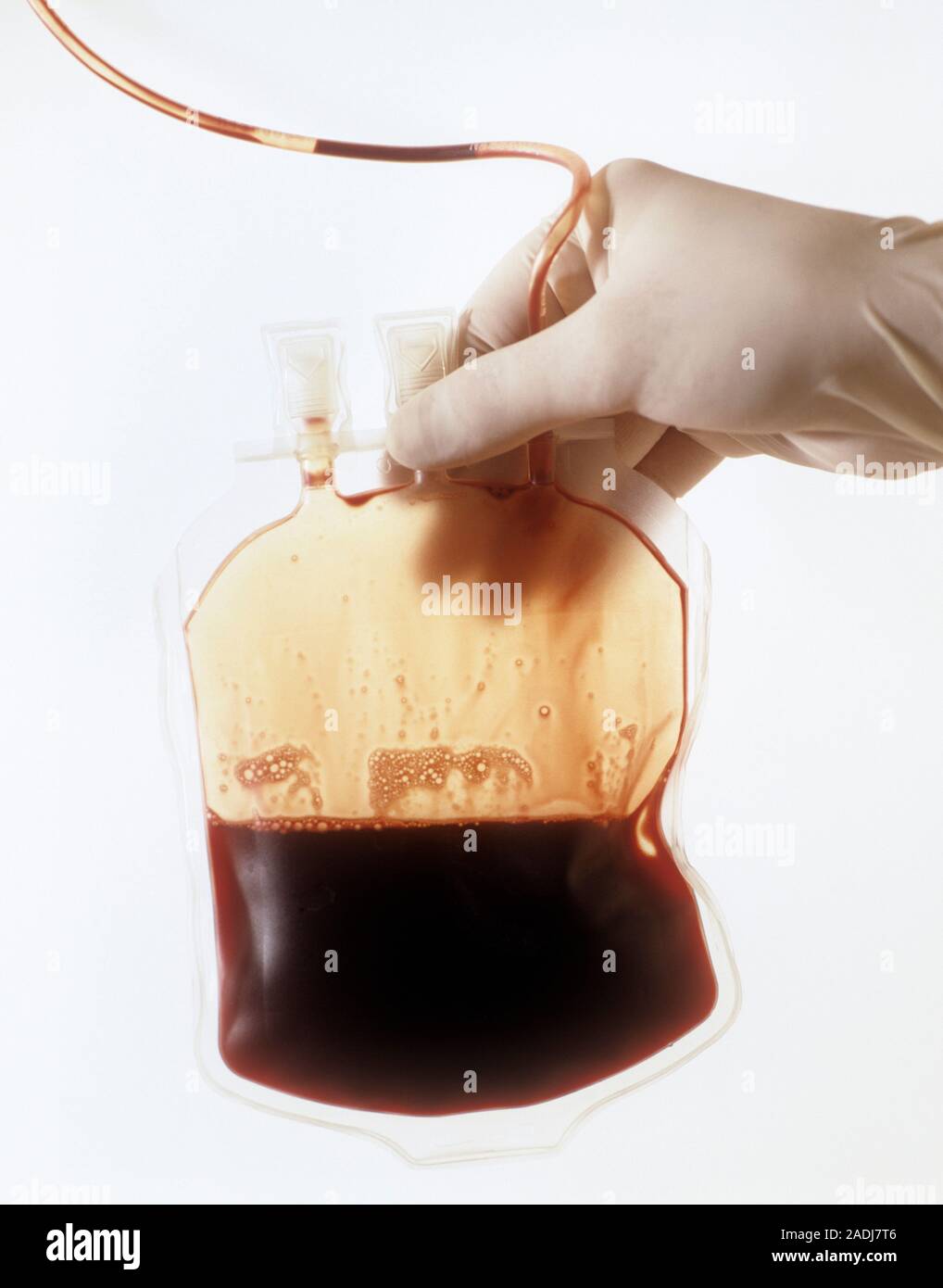 Blood transfusion. Gloved hand holding a blood bag during a transfusion ...