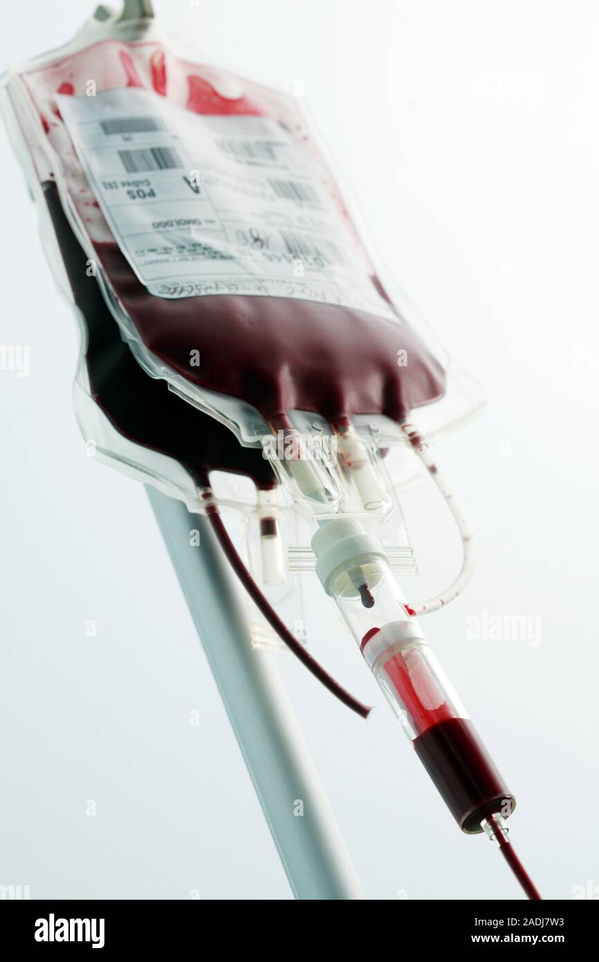 Blood transfusion equipment. Bags of A positive blood hanging on a ...
