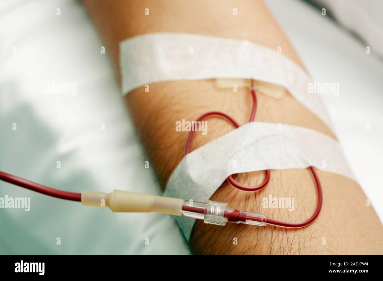 Blood transfusion. Blood-filled tubing attached to a patient's arm ...