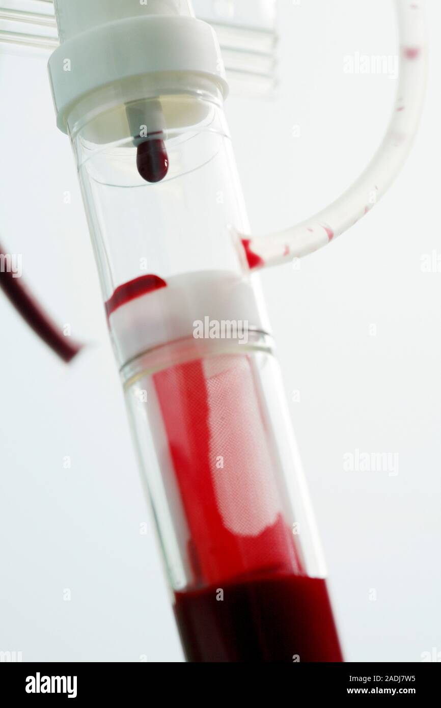 Blood transfusion equipment. Blood dripping from a blood bag (not seen ...