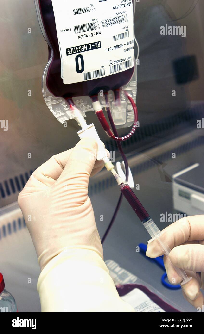 Blood sampling. Technician taking a sample from a bag of blood donated ...