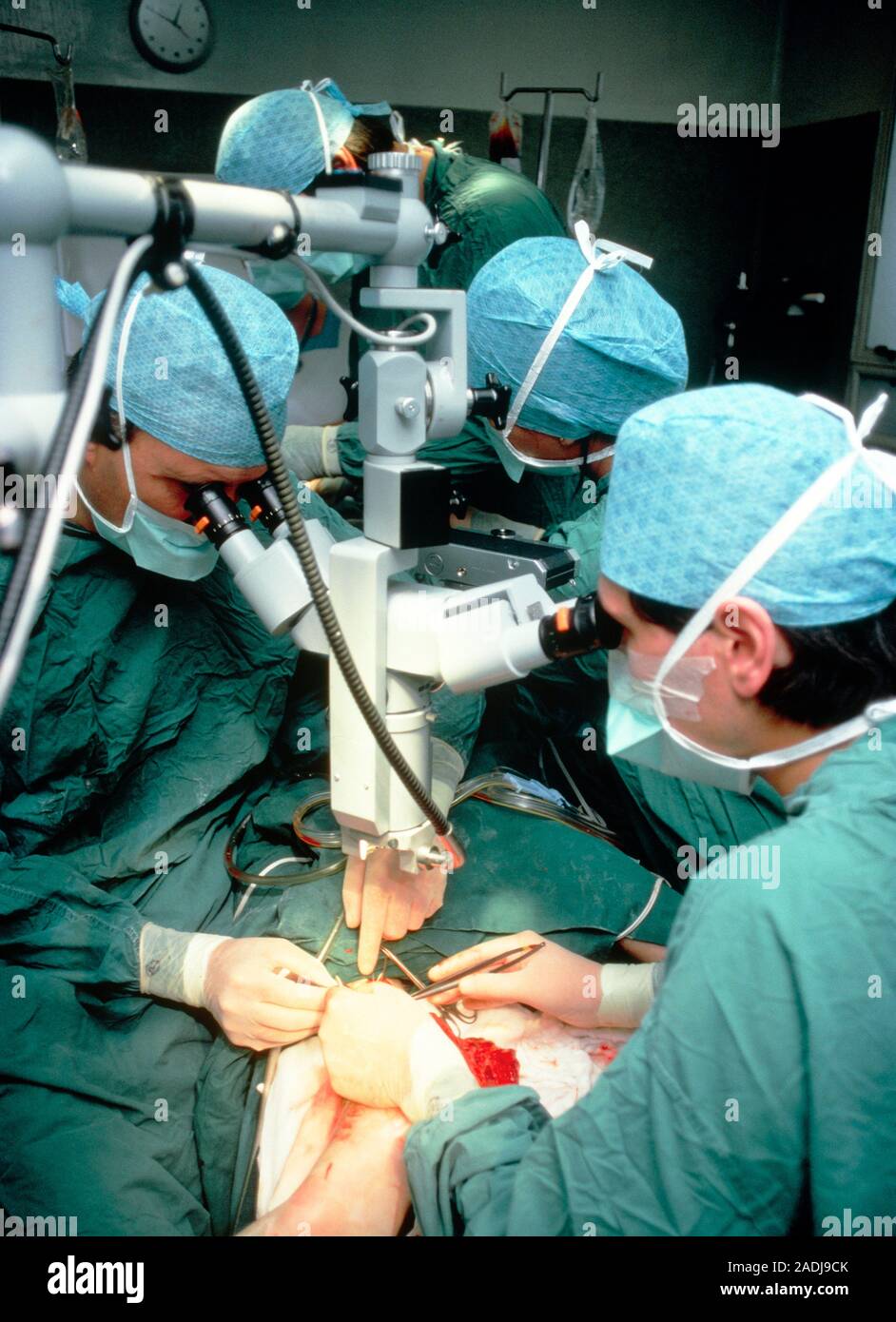 Microsurgery: surgeons using a stereo microscope fitted with dual ...