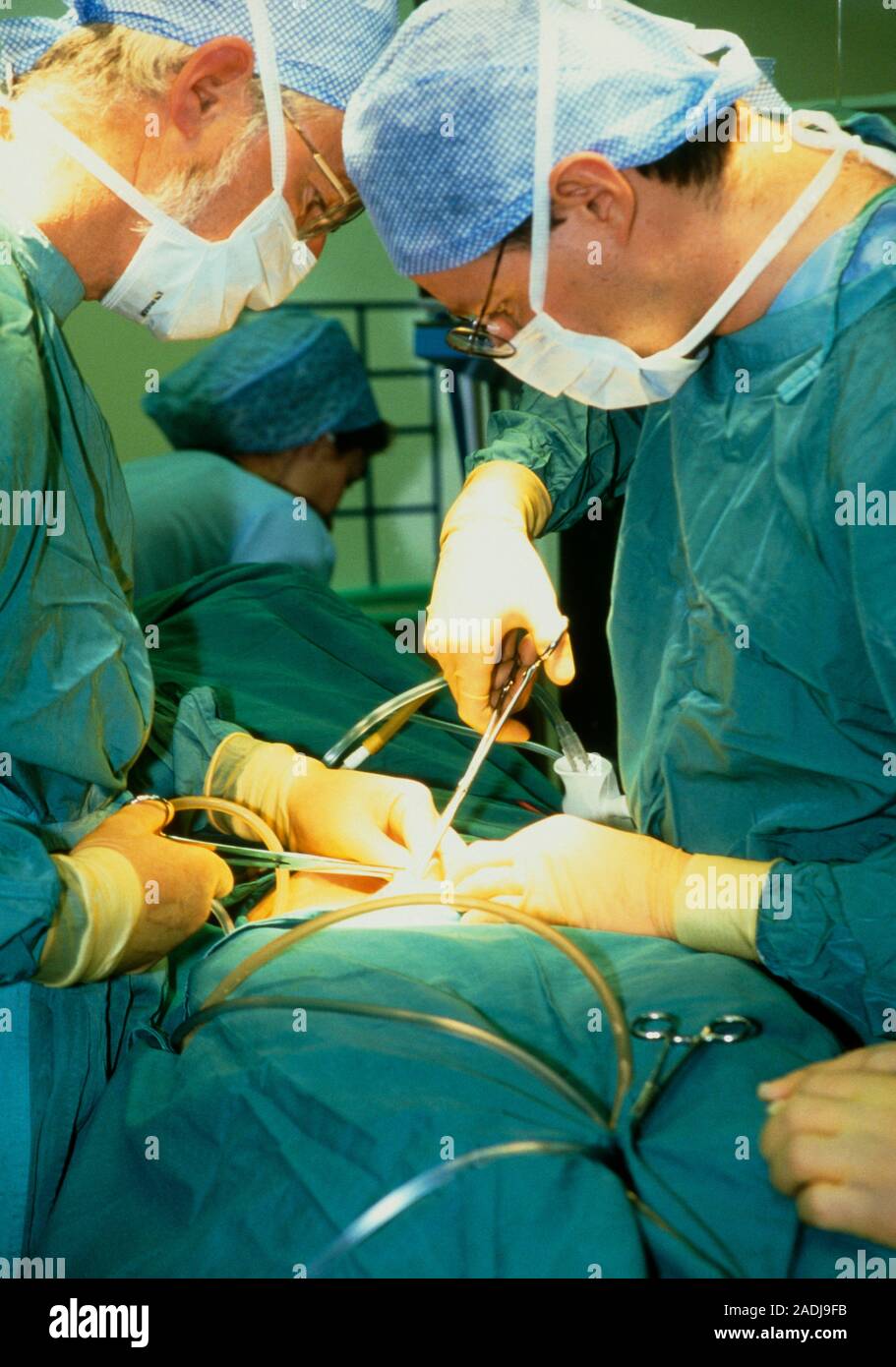 Gall bladder removal. Surgeons during an operation to remove the gall ...
