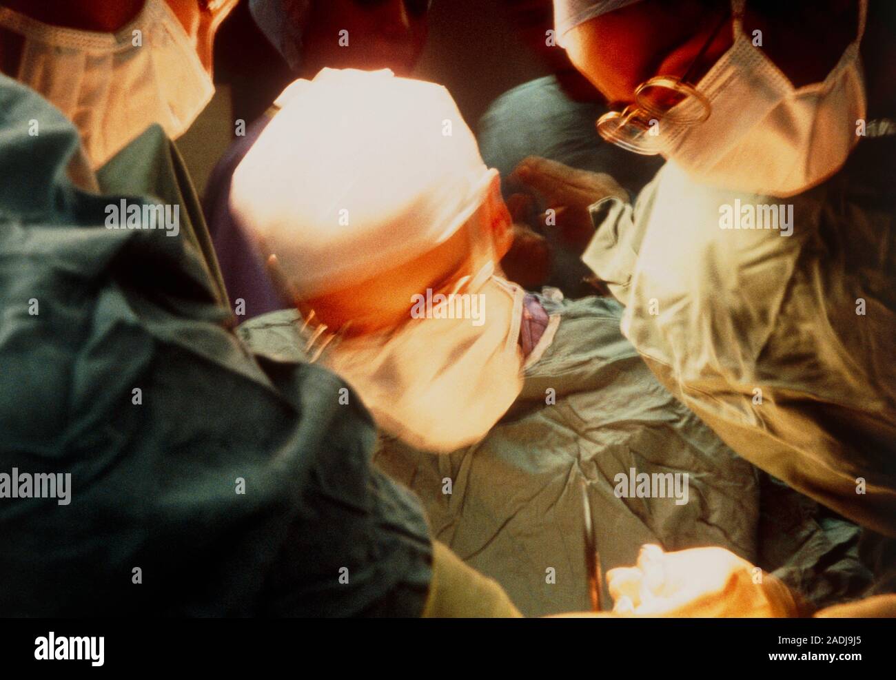 MODEL RELEASED. Surgeon. Male surgeon's face during surgery with a ...
