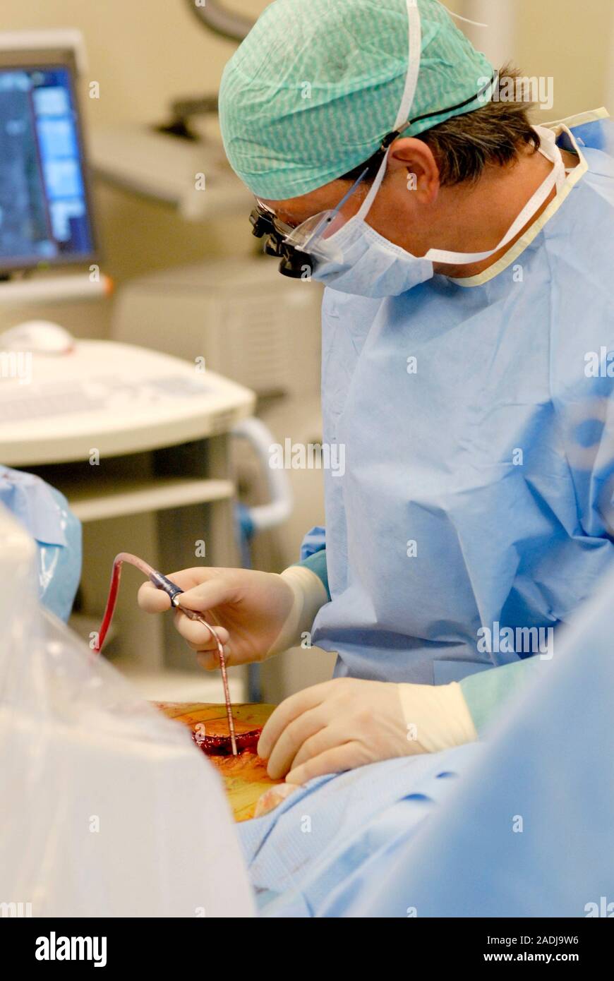 Spinal surgery. Surgeon using a suction tube while operating on a ...