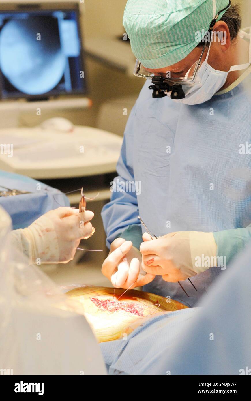 Spinal surgery. Surgeon stitching up a patient after operating on their ...