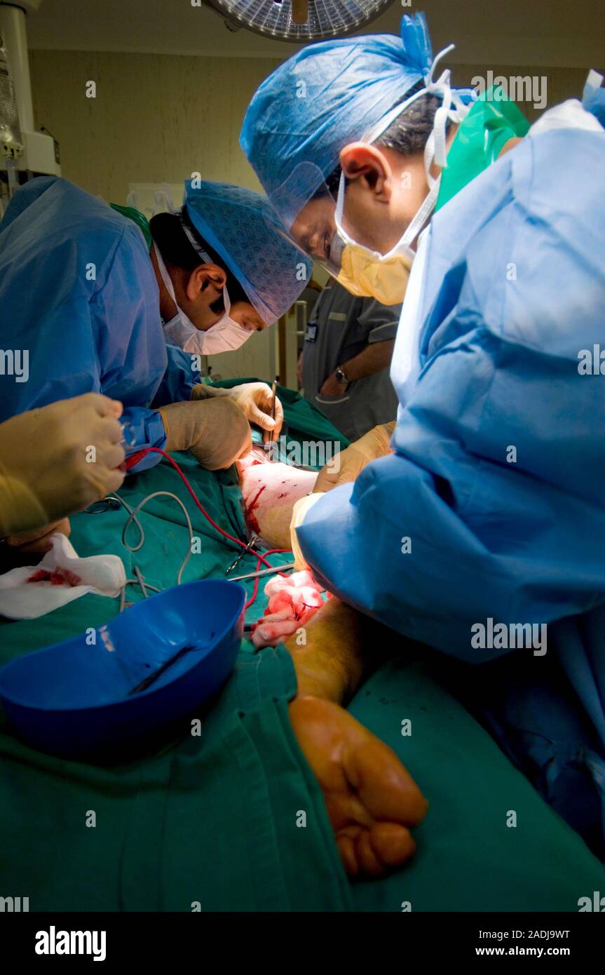 MODEL RELEASED. Varicose vein surgery. Surgical team carrying out an ...