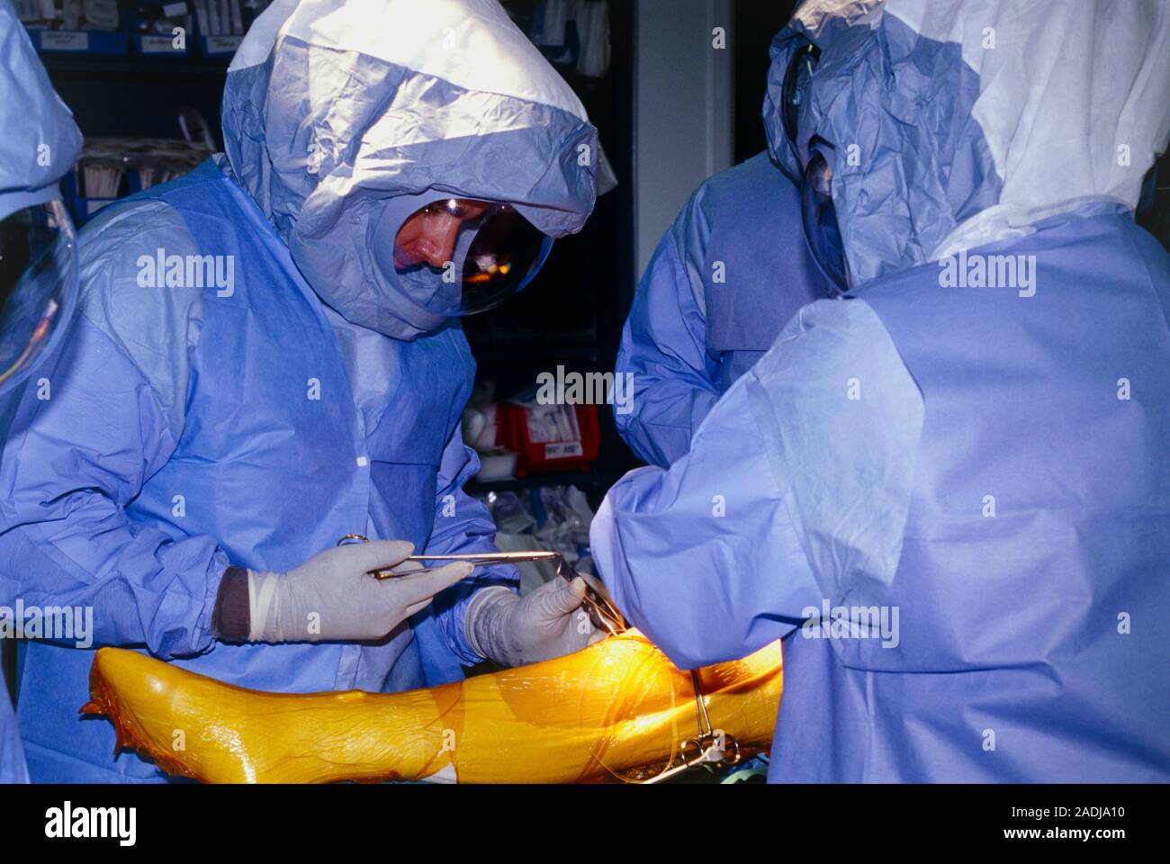 Knee replacement surgery. View of a surgical team performing a knee ...